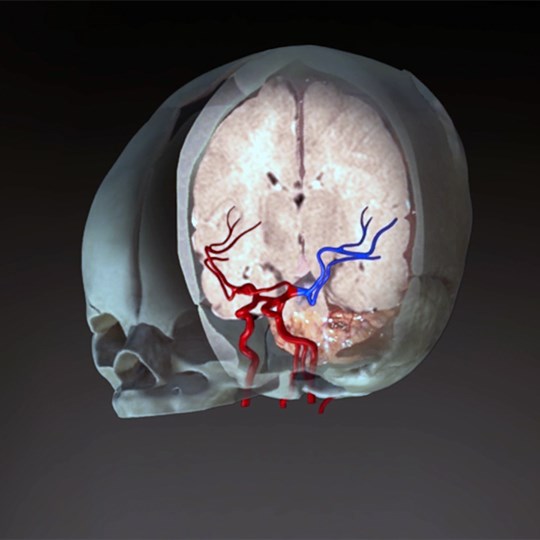 Birth injury animation Animation by Visuals For Law | Medical ...