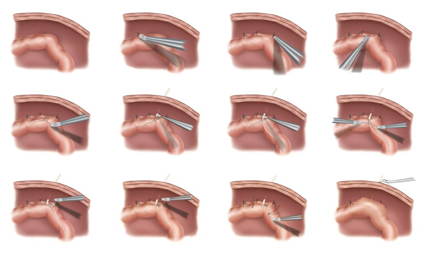 Surgery Procedure Illustration by Michael Cooper | Medical Illustration ...
