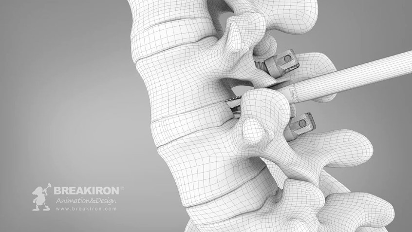 Lumbar Spinal Fusion Illustration by BREAKIRON® Animation&Design ...