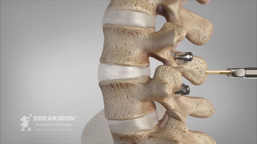 Lumbar Spinal Fusion Illustration by BREAKIRON® Animation&Design ...