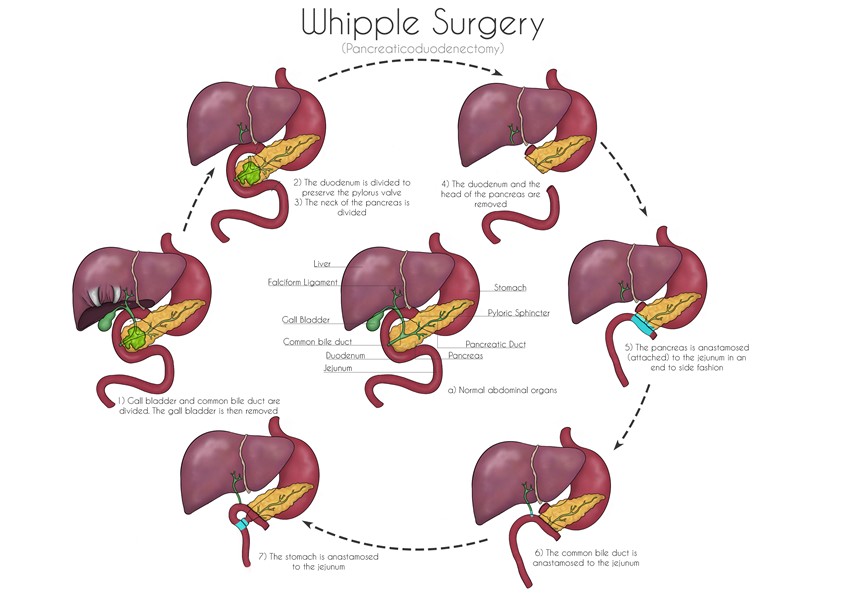 Whipple Procedure Illustration By Anna Clunis Medical Illustration Whipple Procedure Illustration By Anna Clunis Medical Illustration