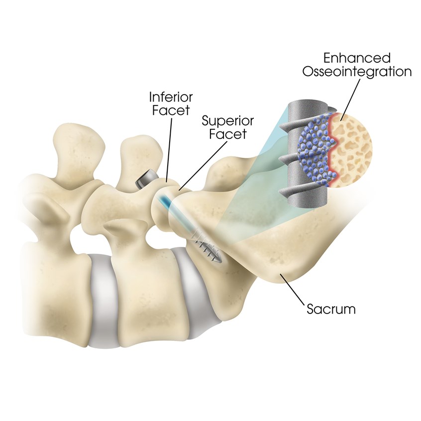 Facet fixation Illustration by IOLITE Creative | Medical Illustration ...