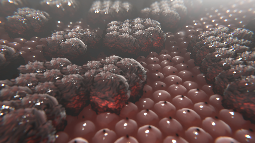 Scar formation in liver cells showing Cirrhosis Illustration by ...