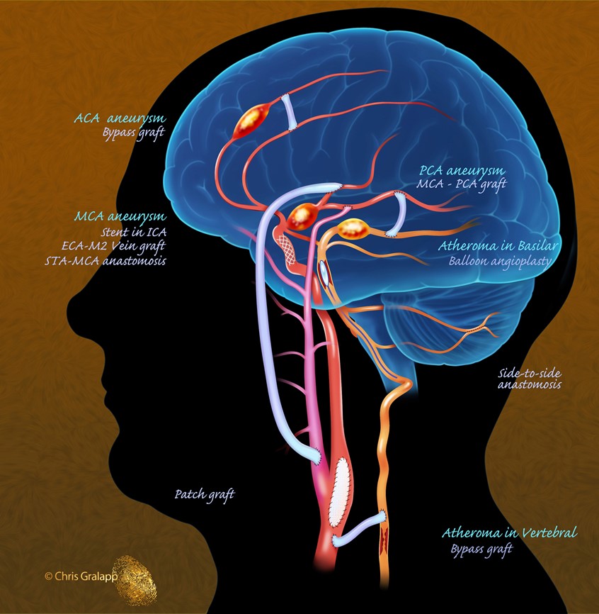 Repair of Various Aneurysms Illustration by Chris Gralapp | Medical ...