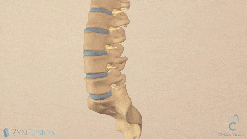 Evolution in Spinal Fusion Animation by Melanie Connolly | Medical ...