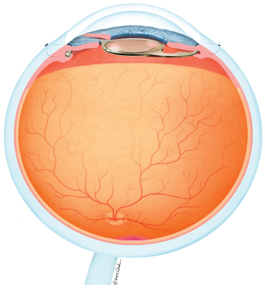 Lens and Cystoid Macular Edema Illustration by N. Lee Wade | Medical ...