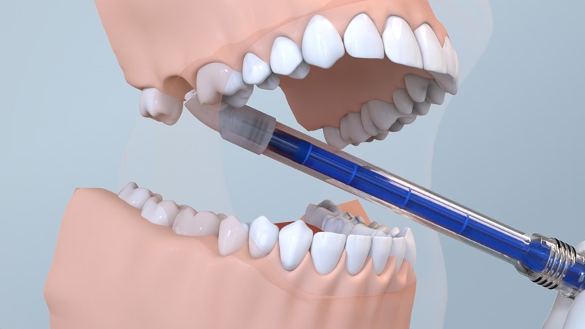 Pen applicator Illustration by Quaint | Medical Illustration & Animation