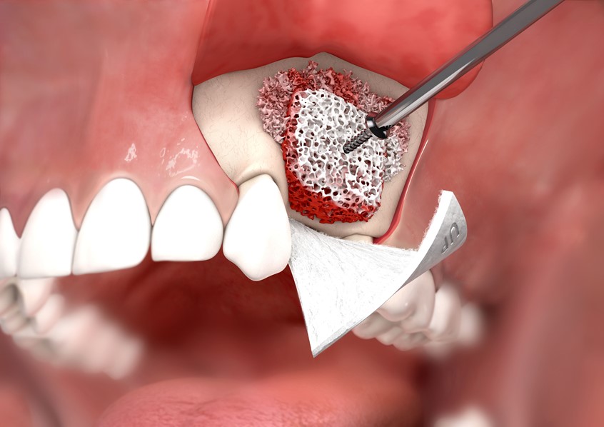 Bone and collagen Biomaterials Illustration by Quaint | Medical ...