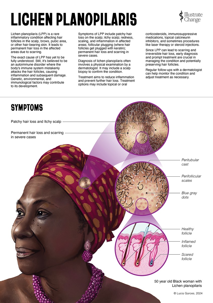 Lichen planopilar poster Illustration by Lucia Garces Torres | Medical ...