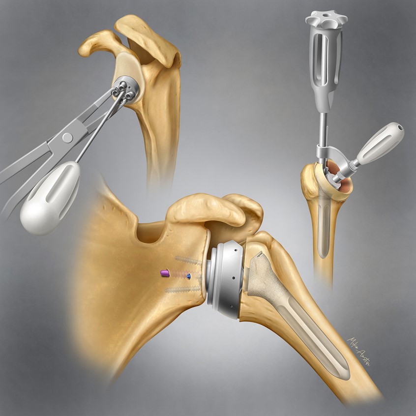 Reverse Total Shoulder Arthroplasty Illustration By Mike Austin Reverse Total Shoulder Arthroplasty Illustration By Mike Austin