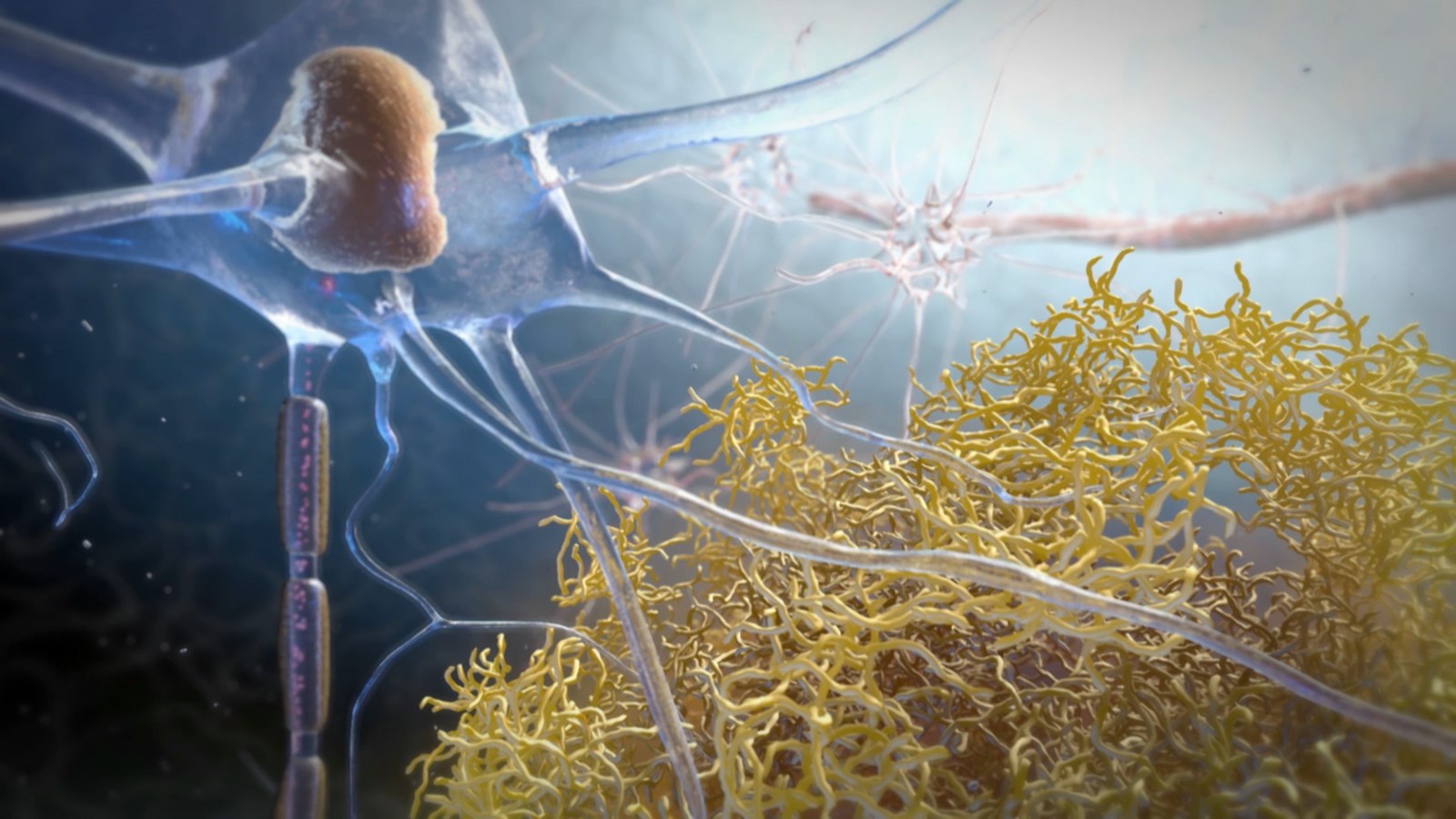 Alzheimer's Disease Illustration by 3FX, inc. | Medical Illustration ...