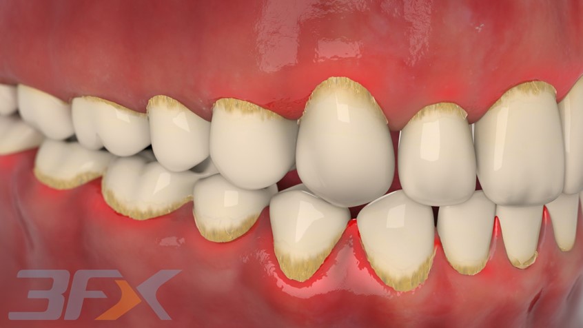 Teeth Plaque Illustration by 3FX, inc. | Medical Illustration & Animation