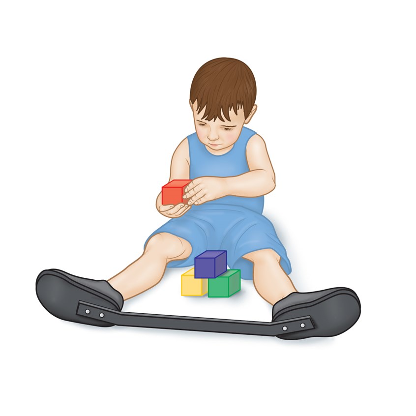 Clubfoot boots and brace Illustration by Wendy Beth Jackelow, MFA, CMI ...