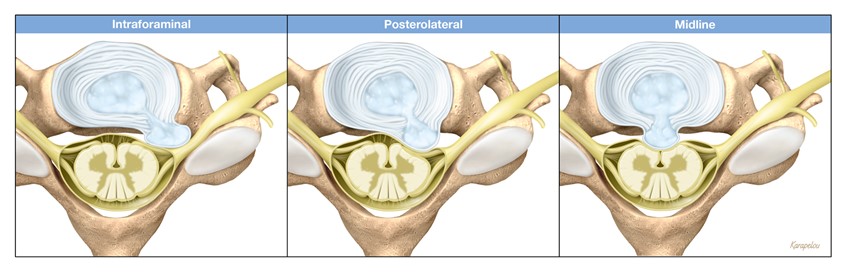 Cervical disk herniation types Illustration by John Karapelou ...