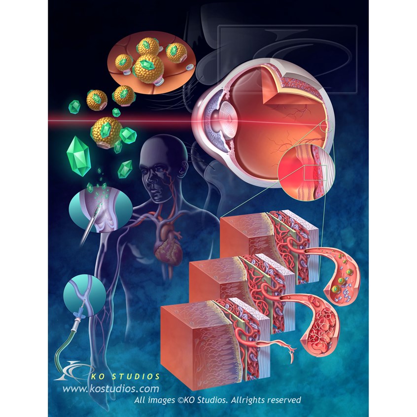 Macular Degeneration Illustration by KO Studios | Medical Illustration ...