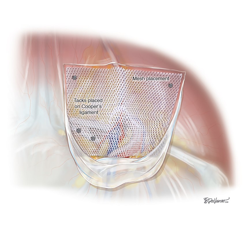 Inguinal Hernia Repair Illustration by Tiffany Slaybaugh Davanzo, MA ...