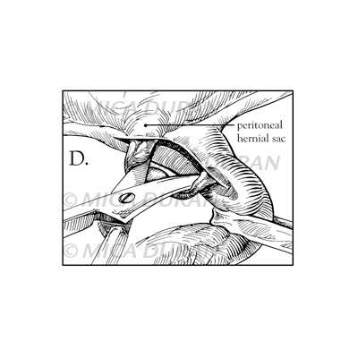 Ink - Hernia Dissection Illustration by Mica Duran | Medical ...
