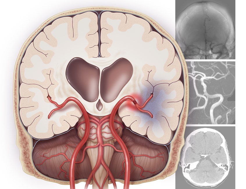 Ischemic Stroke Illustration by Scott Leighton | Medical Illustration ...