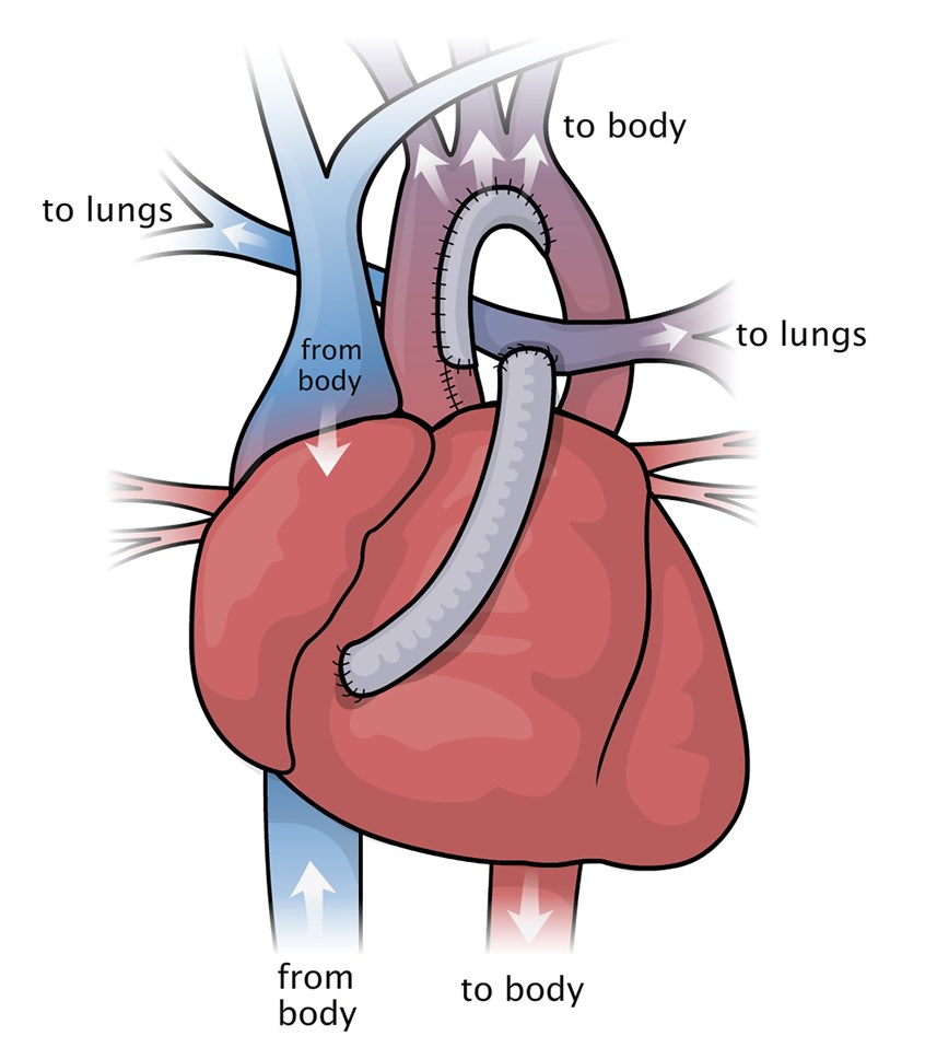 Pediatric cardiology: Norwood procedure Illustration by Third Left ...