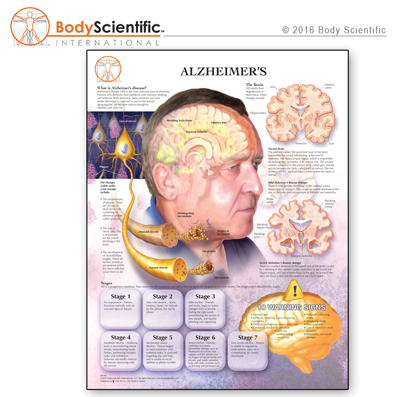 Alzheimer's Illustration by Body Scientific | Medical Illustration ...