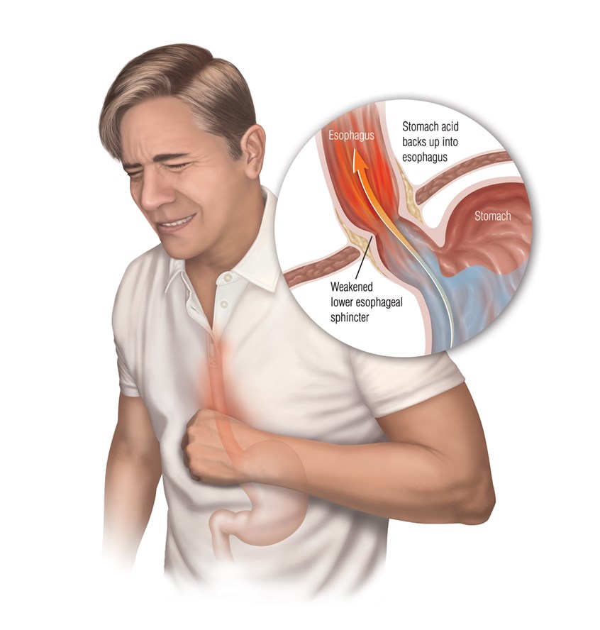 Heartburn Illustration by Kristen Wienandt Marzejon | Medical ...