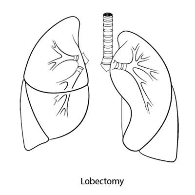 Lobectomy Illustration by MedDraw Studio | Medical Illustration & Animation