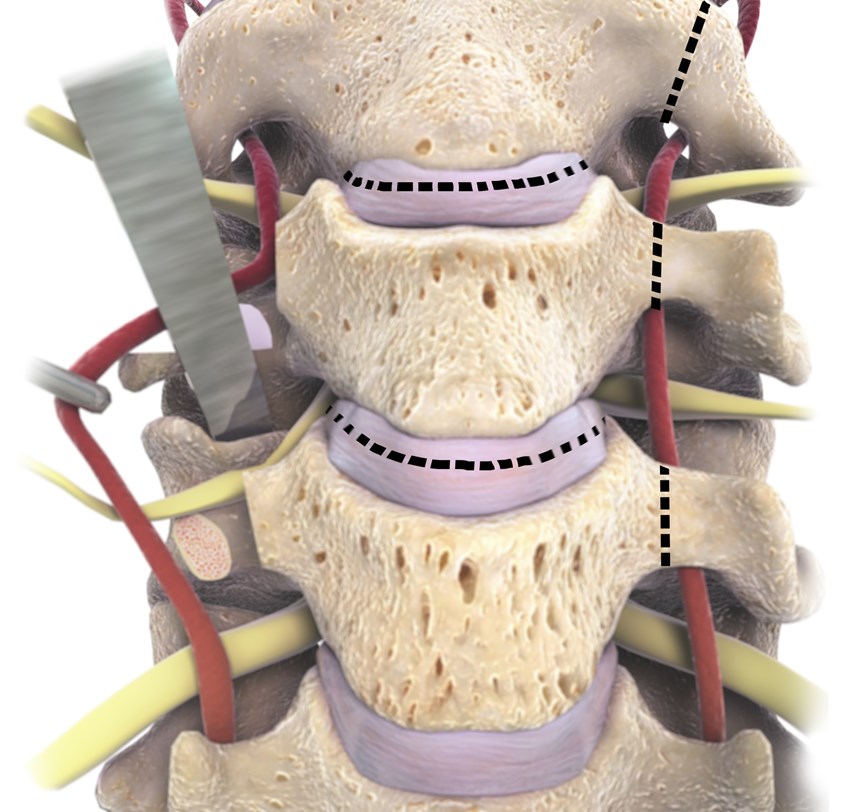 Spine Illustration by ICom Creative Corp | Medical Illustration & Animation