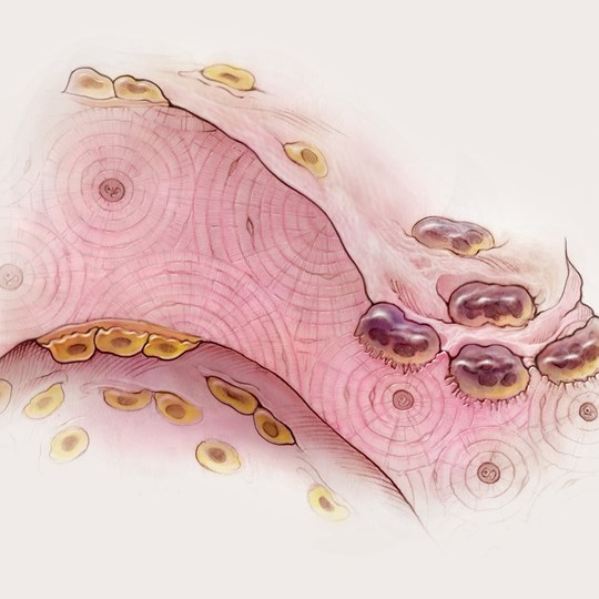 Vaginal Hysterectomy Illustration by Scott Bodell | Medical ...