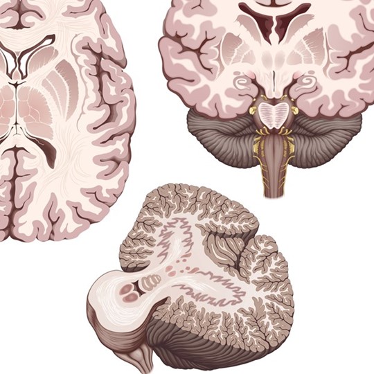 Symptoms of minor epileptic seizure Illustration by Maury Aaseng ...