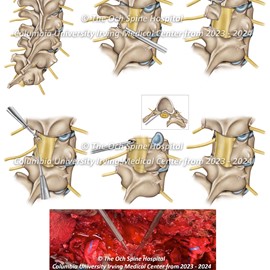 Adult Acquired Hydrocele Illustration by Krystal Thompson | Medical ...