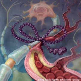 Laparoscopic Left Dermoid Ovarian Cystectomy Illustration by Keri Leigh ...