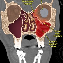 C1 and C2 Normal vs Condition Illustration by Joanna Robinson | Medical ...