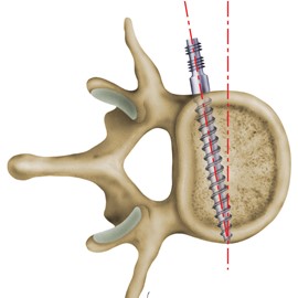 Corpectomy Illustration by N. Lee Wade | Medical Illustration & Animation