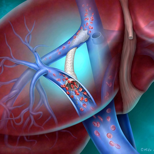 Peripheral Stent Graft Illustration by Mike Austin | Medical ...