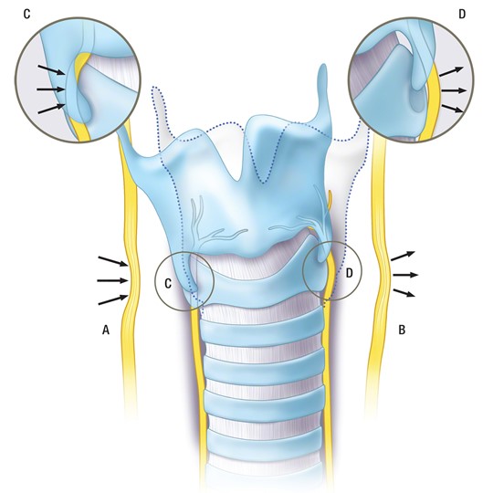Phacoemulsification for Cataract Surgery Illustration by Carol Hrejsa ...