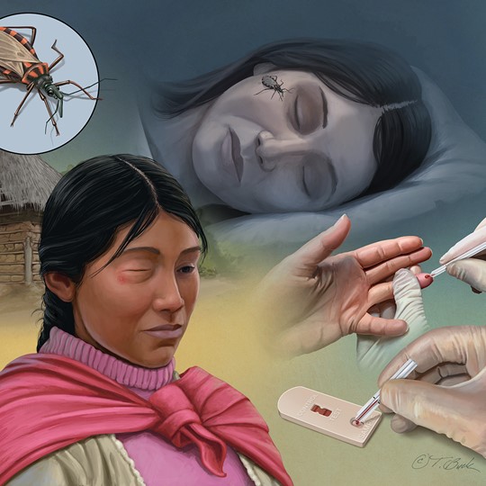 Cutaneous Leishmaniasis (CL) Illustration by Todd Buck | Medical ...