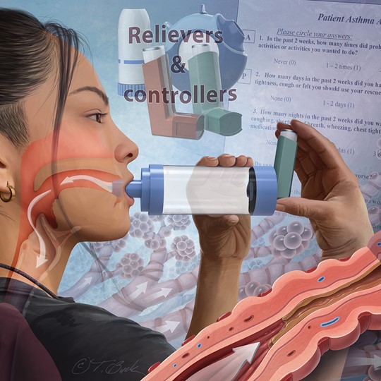 Heartburn Illustration by Todd Buck | Medical Illustration & Animation