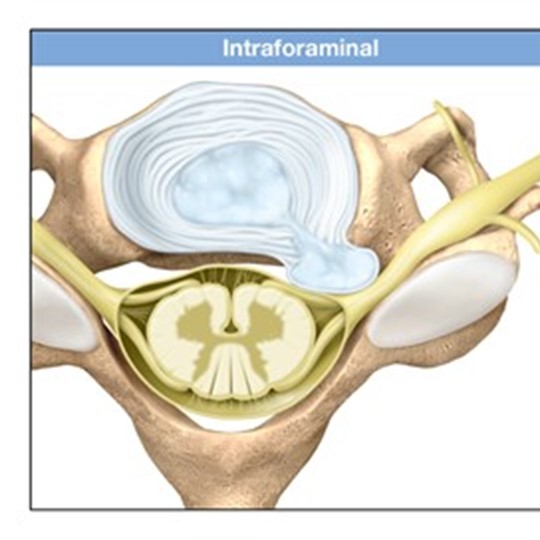 Intervertebral ligaments of the spine Illustration by John Karapelou ...