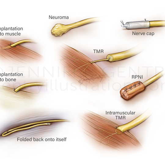 Tulavi nerve cap reduces neuroma formation Illustration by Jennifer ...