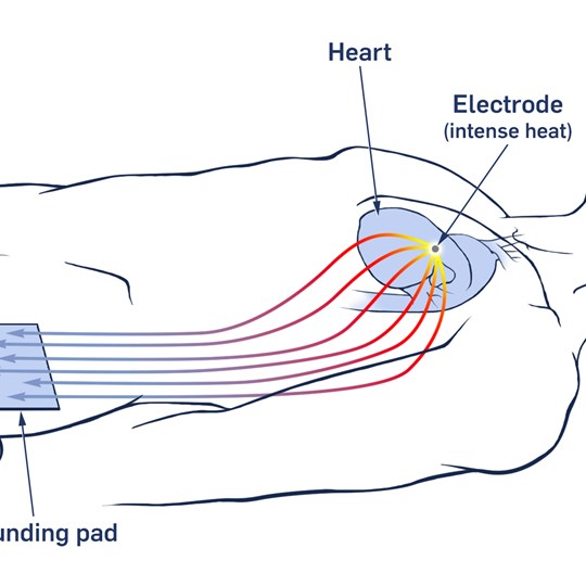 STIC Lesion Illustration by Adam Questell | Medical Illustration ...