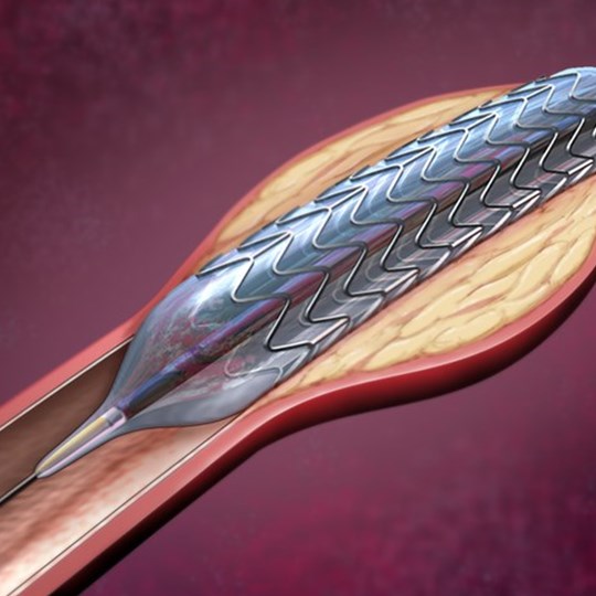 Hip Replacement Surgery Illustration by Scott Leighton | Medical ...