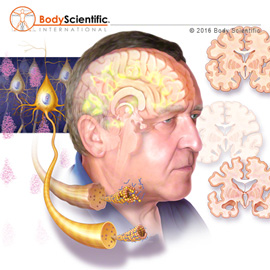 Amniocentesis Illustration by Body Scientific | Medical Illustration ...